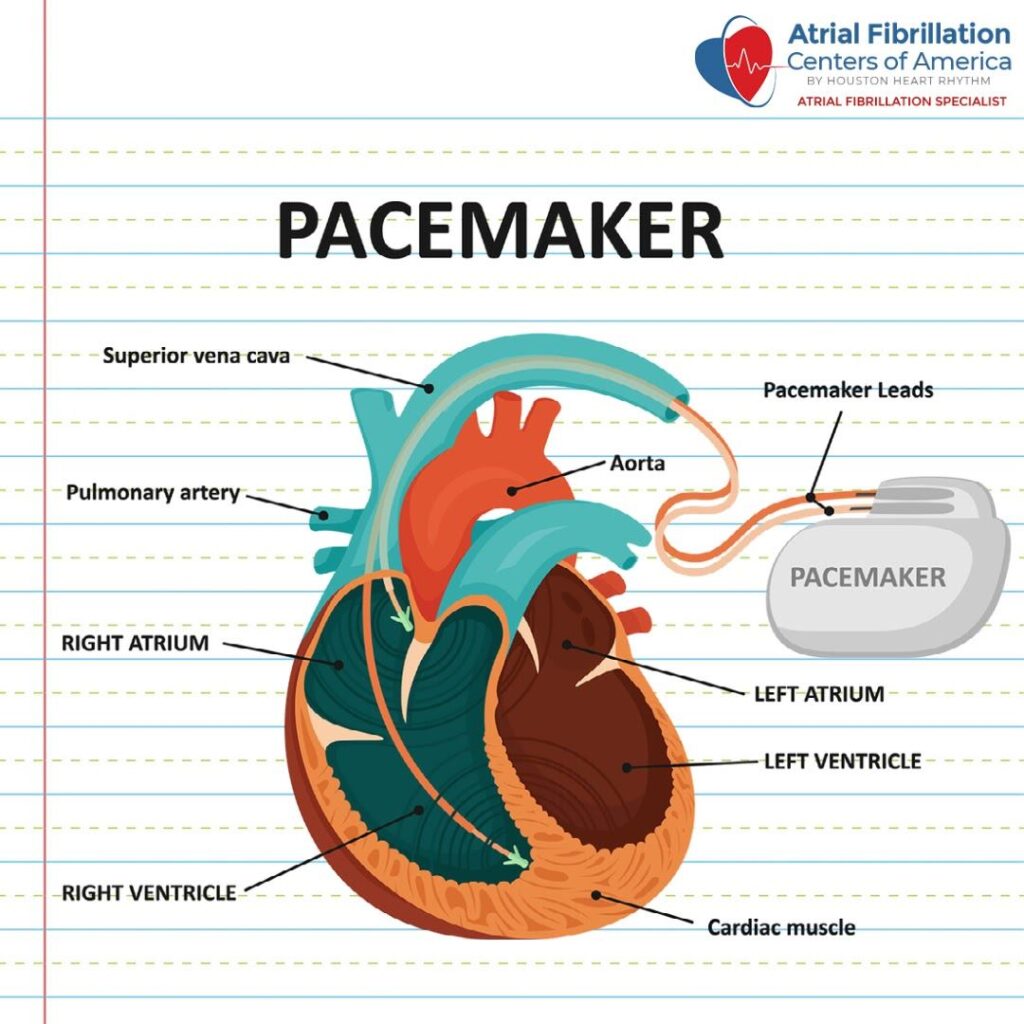 Living with a Pacemaker | Things Can’t Do With It Inside