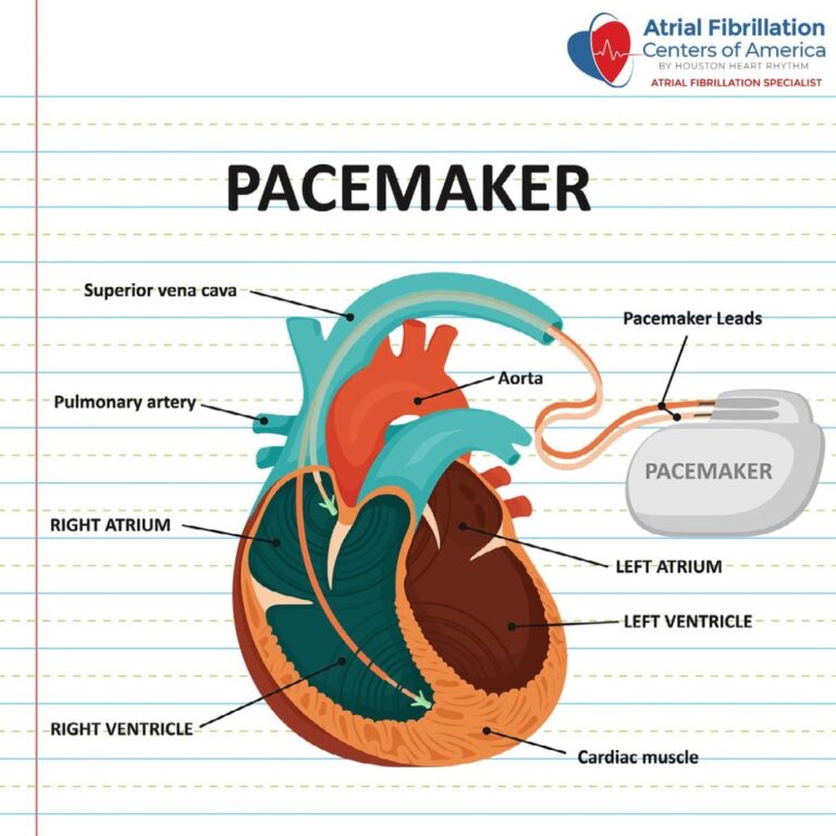Living with a Pacemaker | Things Can’t Do With It Inside